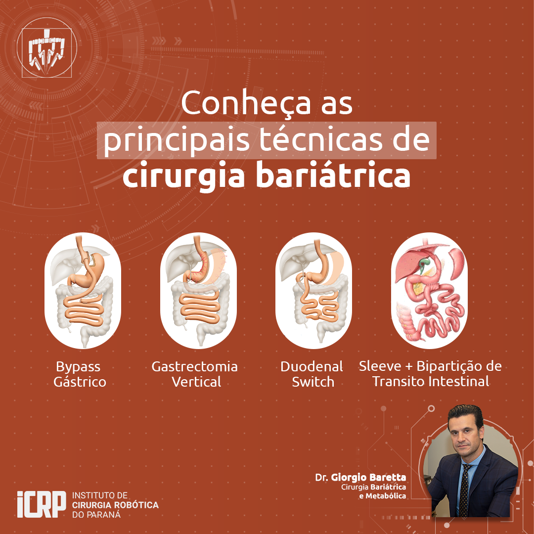 CONHEÇA AS PRINCIPAIS TÉCNICAS DE CIRURGIA BARIÁTRICA - Instituto de ...